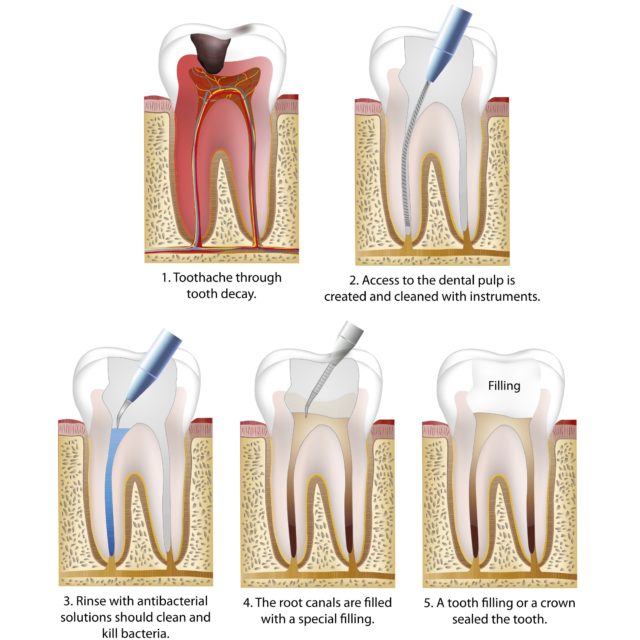 Root Canals – Princeton Dental Clinic