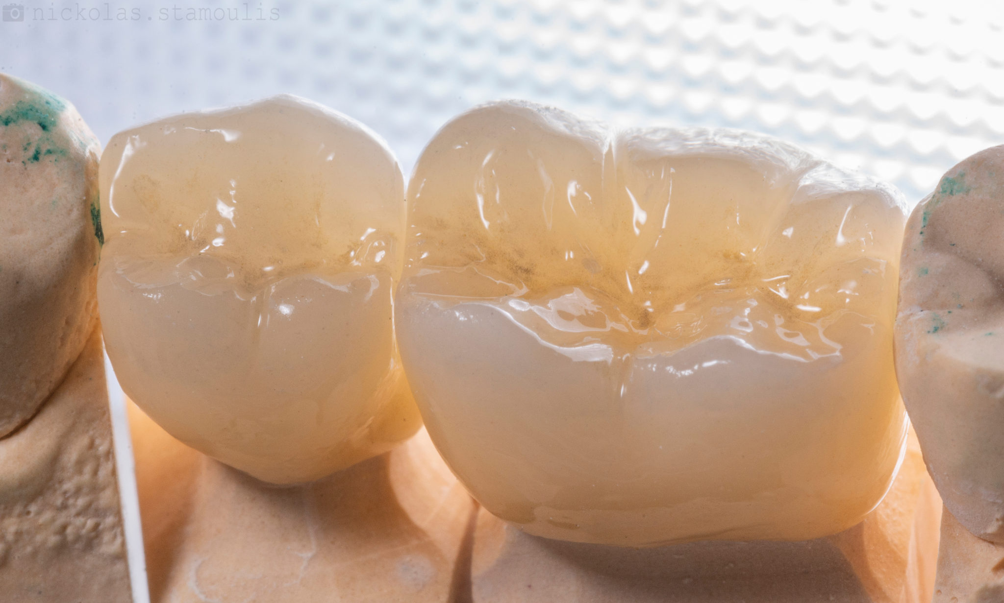 Crowns and Bridges – Princeton Dental Clinic