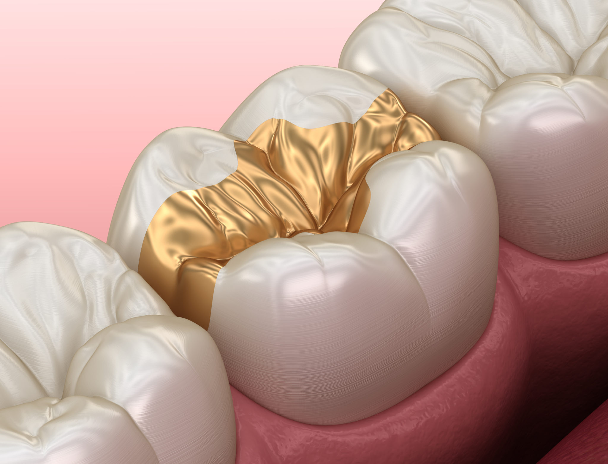 Fillings – Princeton Dental Clinic